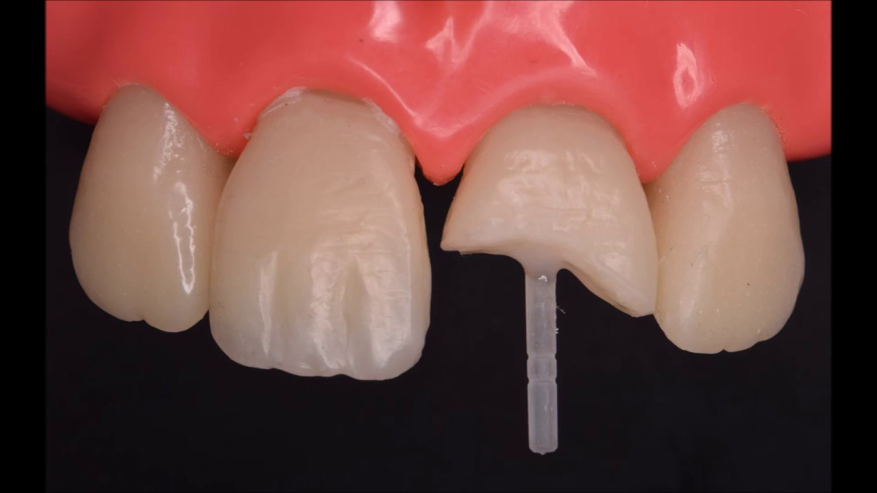 PERNO ESTÉTICO O PERNO DE FIBRA DE VIDRIO - Clínica Dental Odontologists