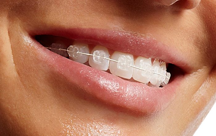 BRACKETS ZAFIRO | Odontologists