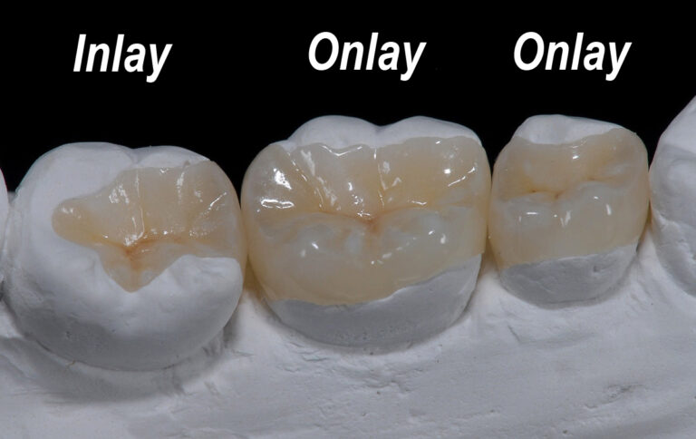 ENDOCROWNS ¿QUÉ ES? ¿PARA QUE SIRVE? - Clínica Dental Odontologists