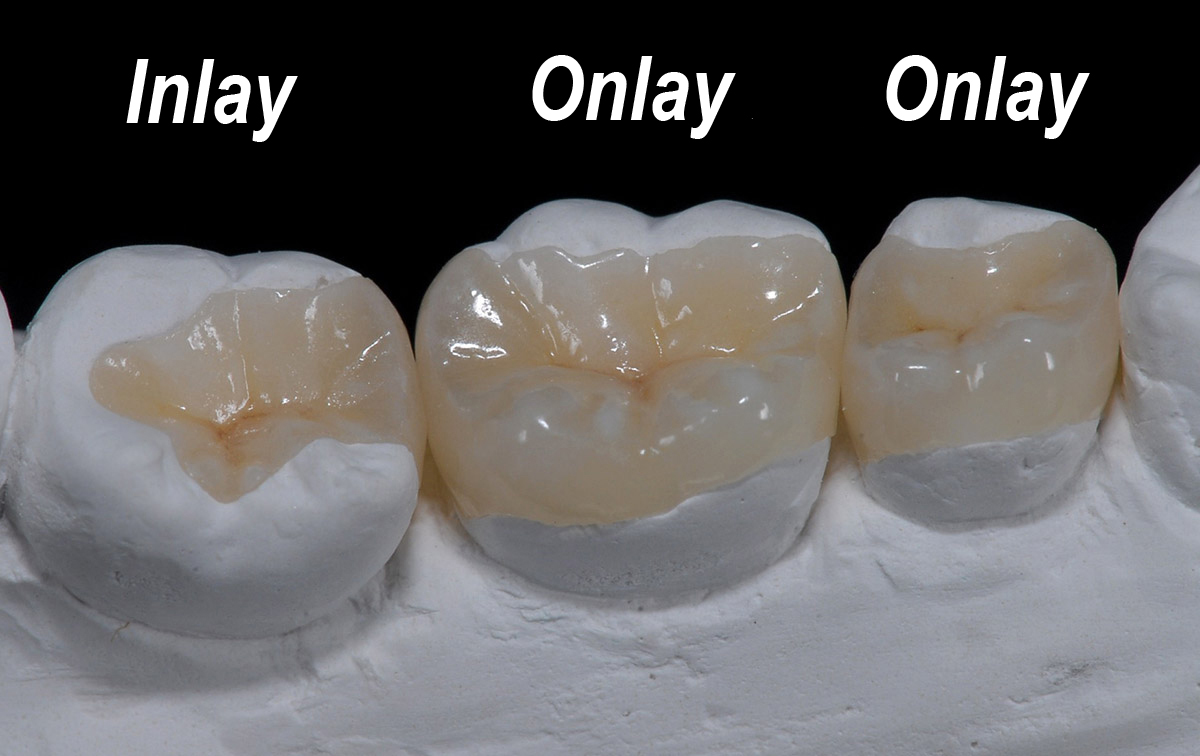ENDOCROWNS ¿QUÉ ES? ¿PARA QUE SIRVE? - Clínica Dental Odontologists