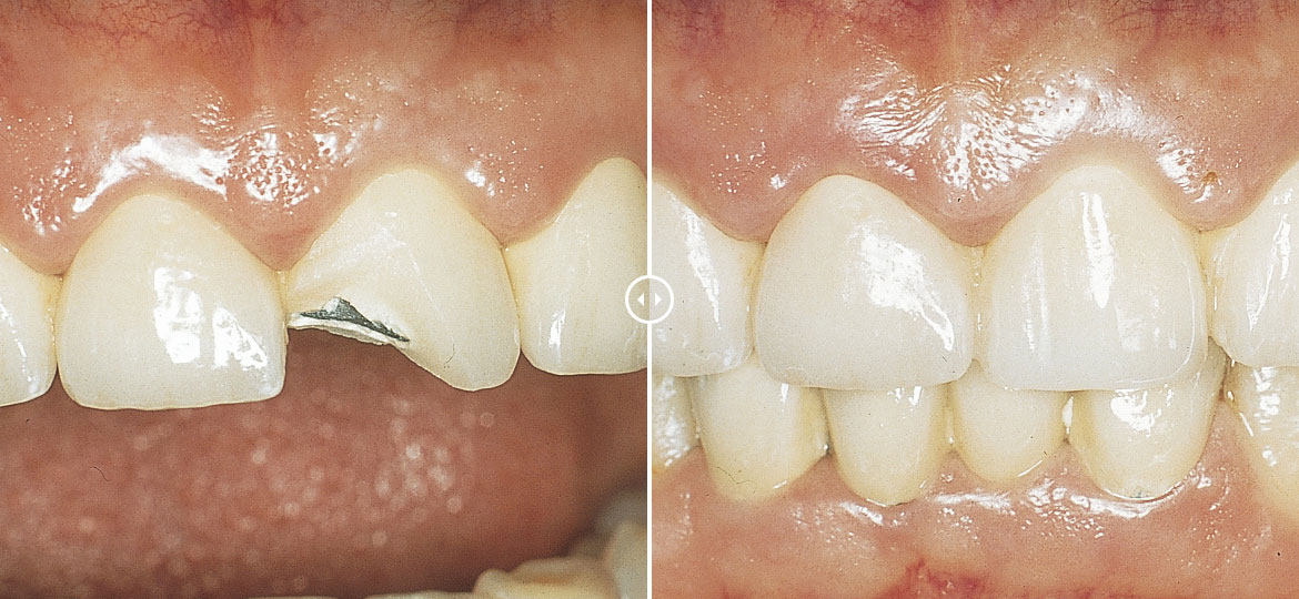 ENDOCROWNS ¿QUÉ ES? ¿PARA QUE SIRVE? - Clínica Dental Odontologists