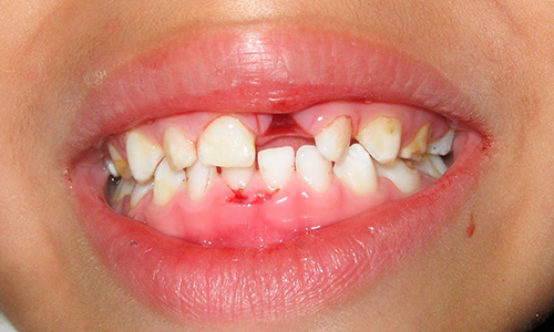 avulsion 1 | Odontologists