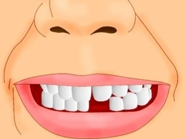 Dientes flojos: Causas y tratamientos - Clínica Dental Odontologists