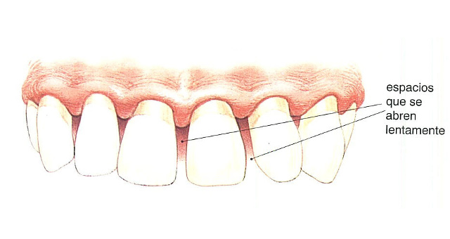 periodontitis-la-enfermedad-de-los-dientes-flojos | Odontologists